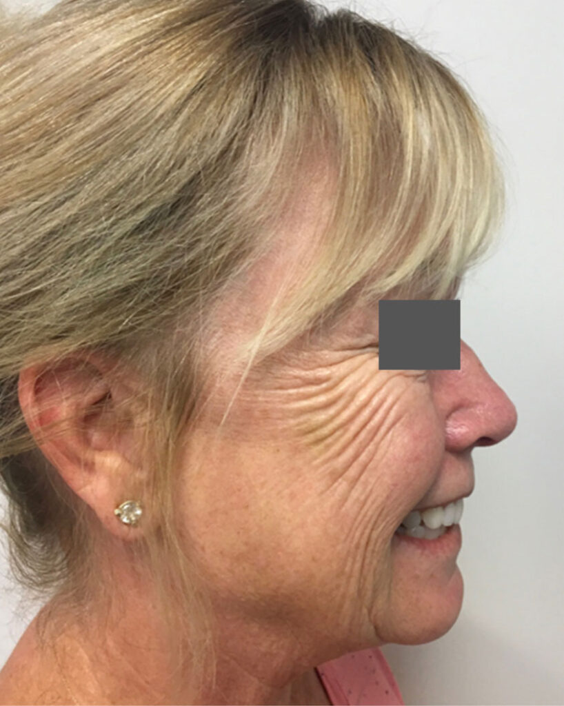 BOTOX Cosmetic Treatments | Halcyon Dermatology